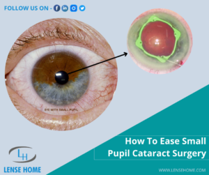 Managing Small-Pupil Cataract Surgery with Pupil Expander - LENSE HOME